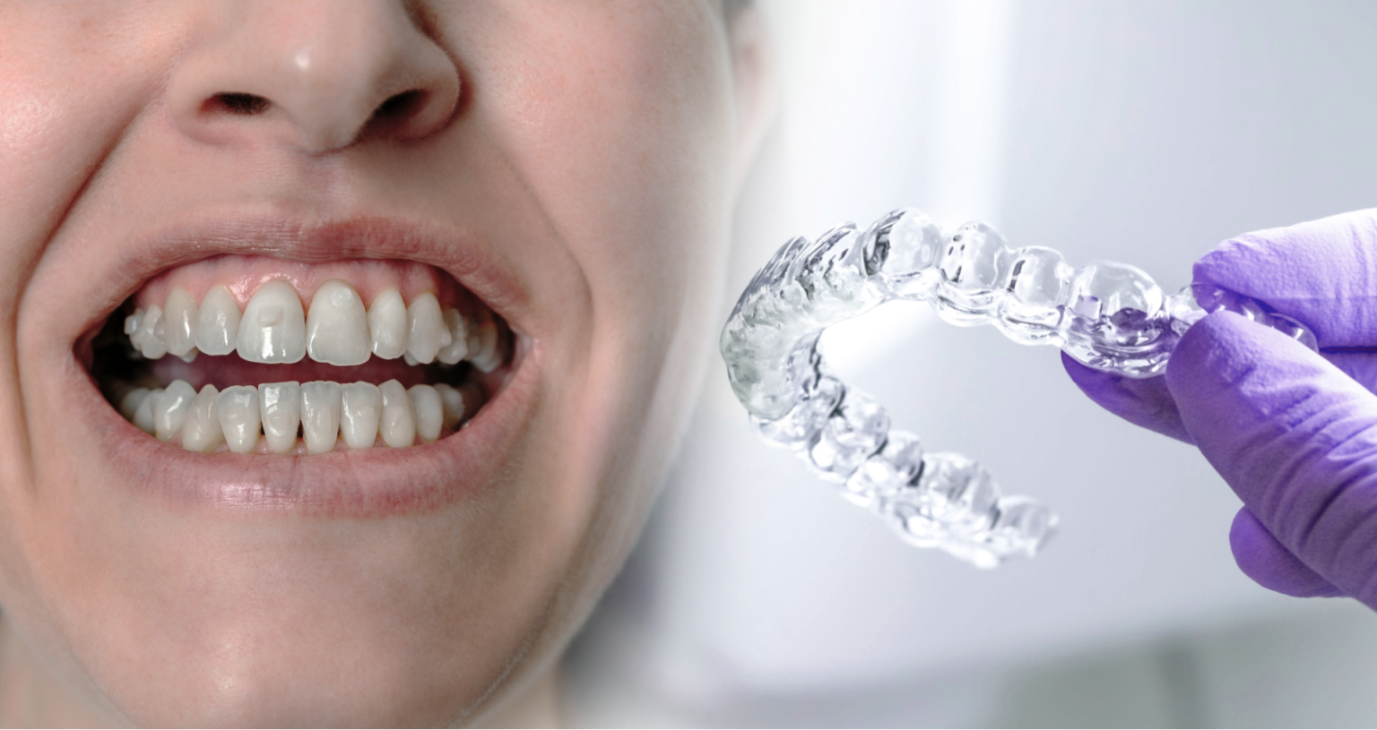 Invisalign Attachments What Are They And How Do They Work 